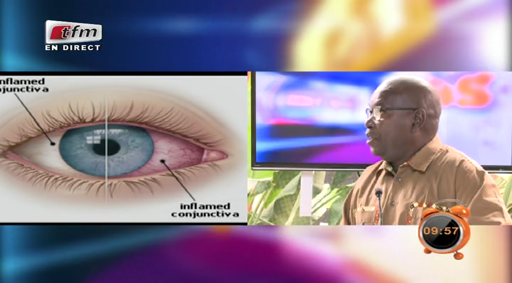 Vidéo:Astuce Santé:La maladie des yeux “Apolo” ou conjonctivite:les ...